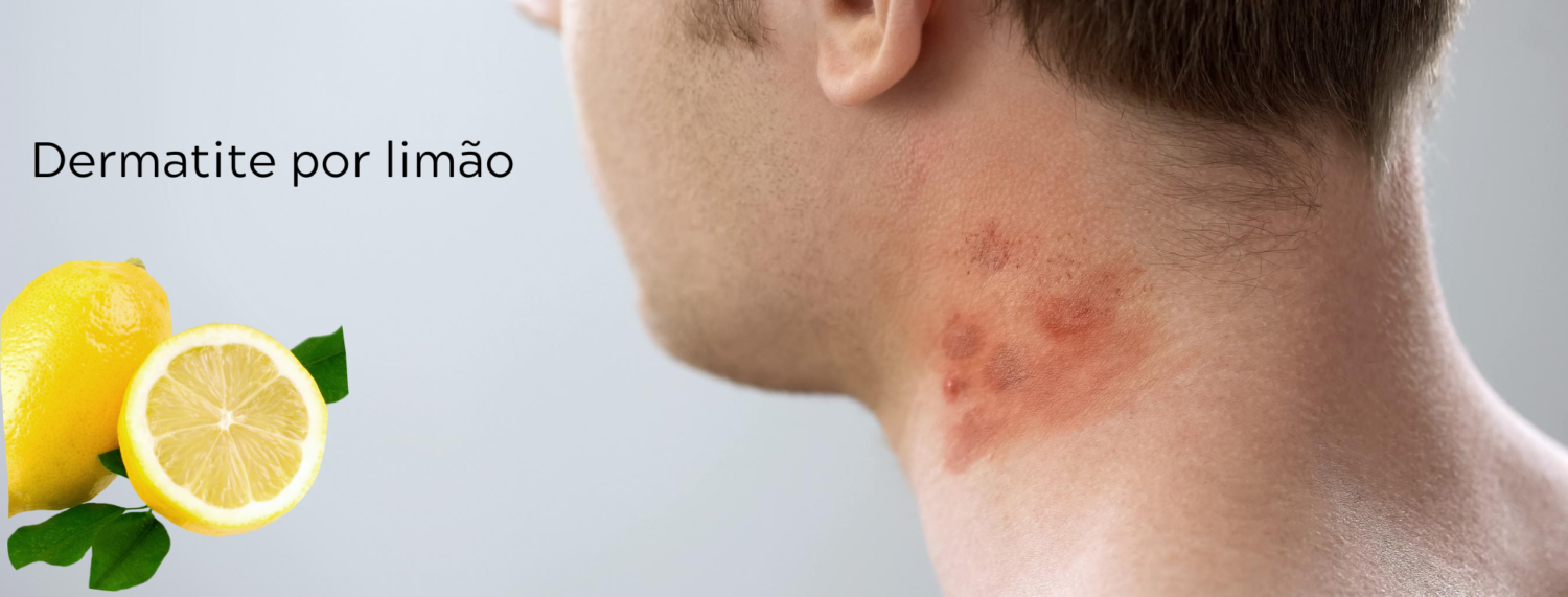 Dermatite de contato na face | Dra. Claudia Sá | Dermatologista